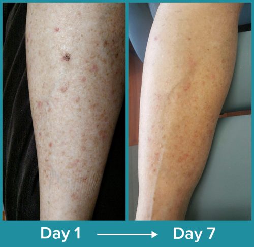 Review - Chemotherapy Rash - CP - NeoGenesis Pro Australia