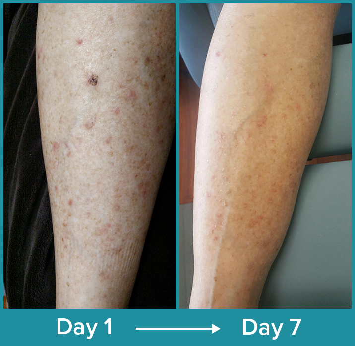 Review - Chemotherapy Rash - CP - NeoGenesis Pro Australia