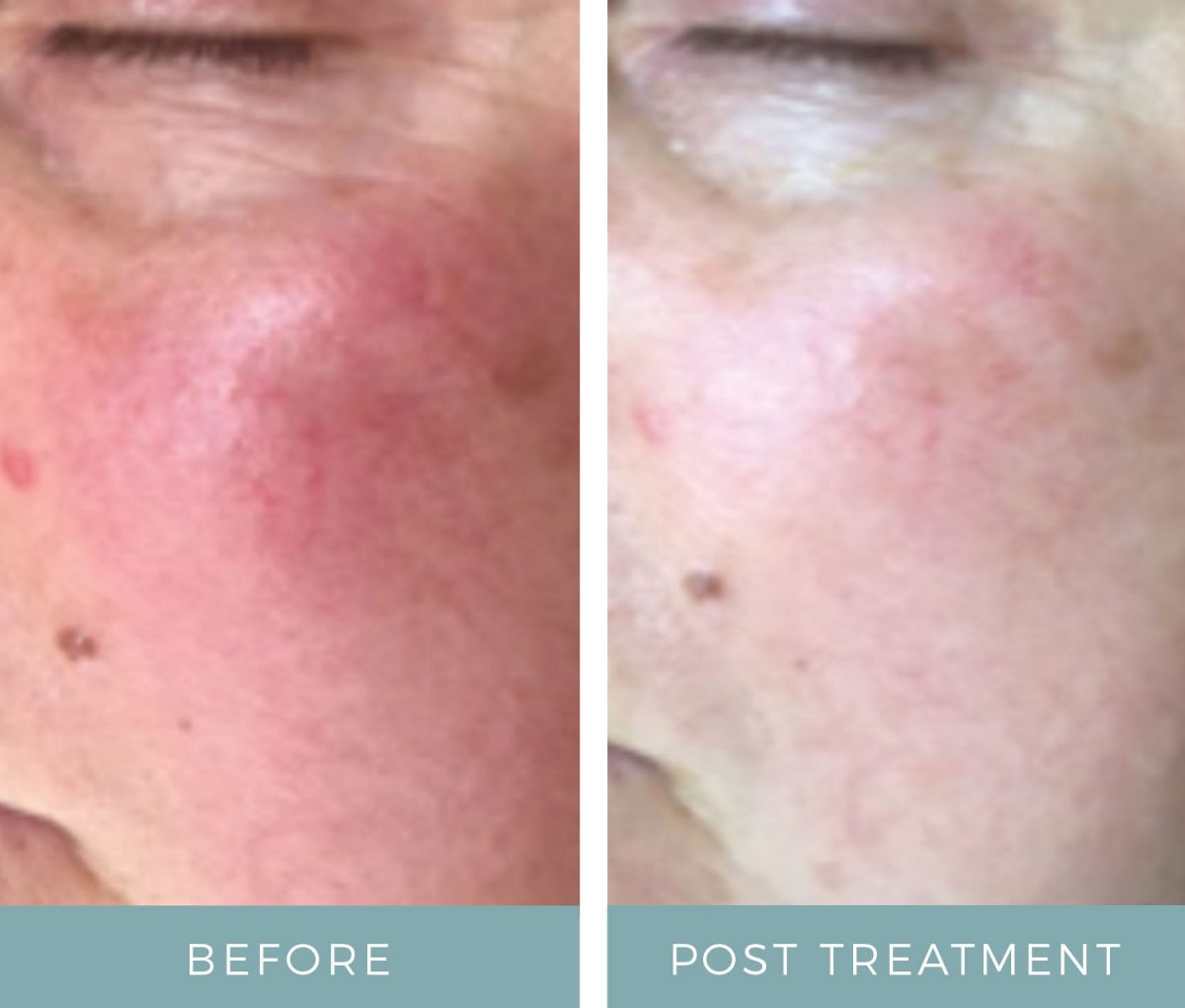 Rosacea NeoGenesis Skincare Products for Rosacea
