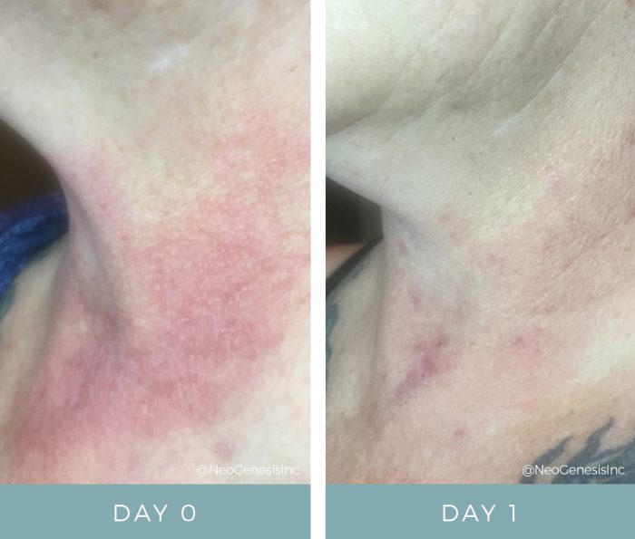 Chemical Peel Review Reaction to Chemical Peel Recovery Serum