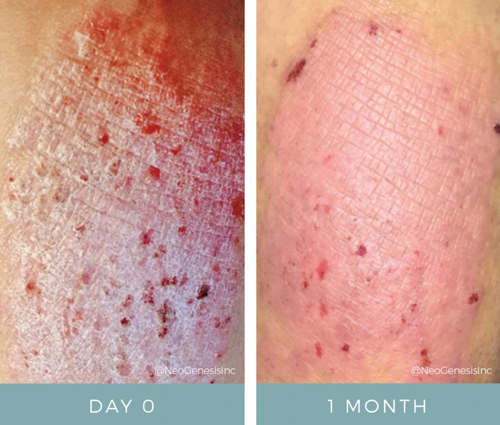 Dermatitis NeoGenesis Inc Skin Care Dermatitis Stem Cell Cosmeceuticals