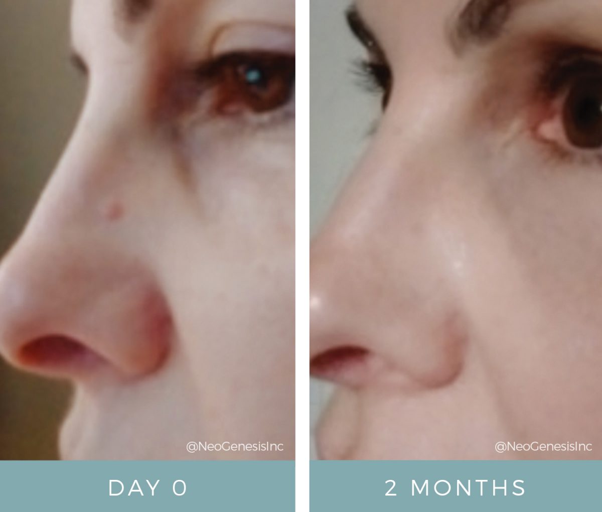 Hyperkeratosis Review NeoGenesis Recovery for Hyperkeratosis