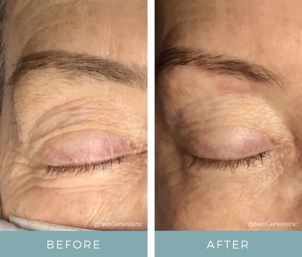 Microcurrent NeoGenesis Skincare Products with Microcurrent for Facials