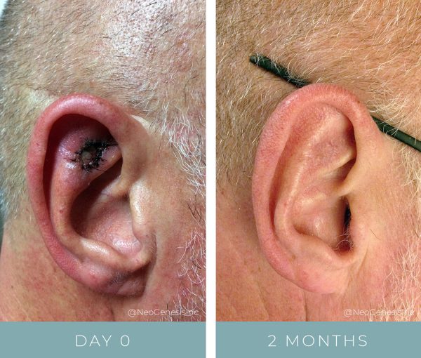 Post Surgery Cancer Skincare Wound Healing Minimize Scarring Oncology