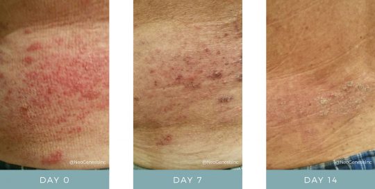 Review - Shingles - Mark S - NeoGenesis Pro Australia