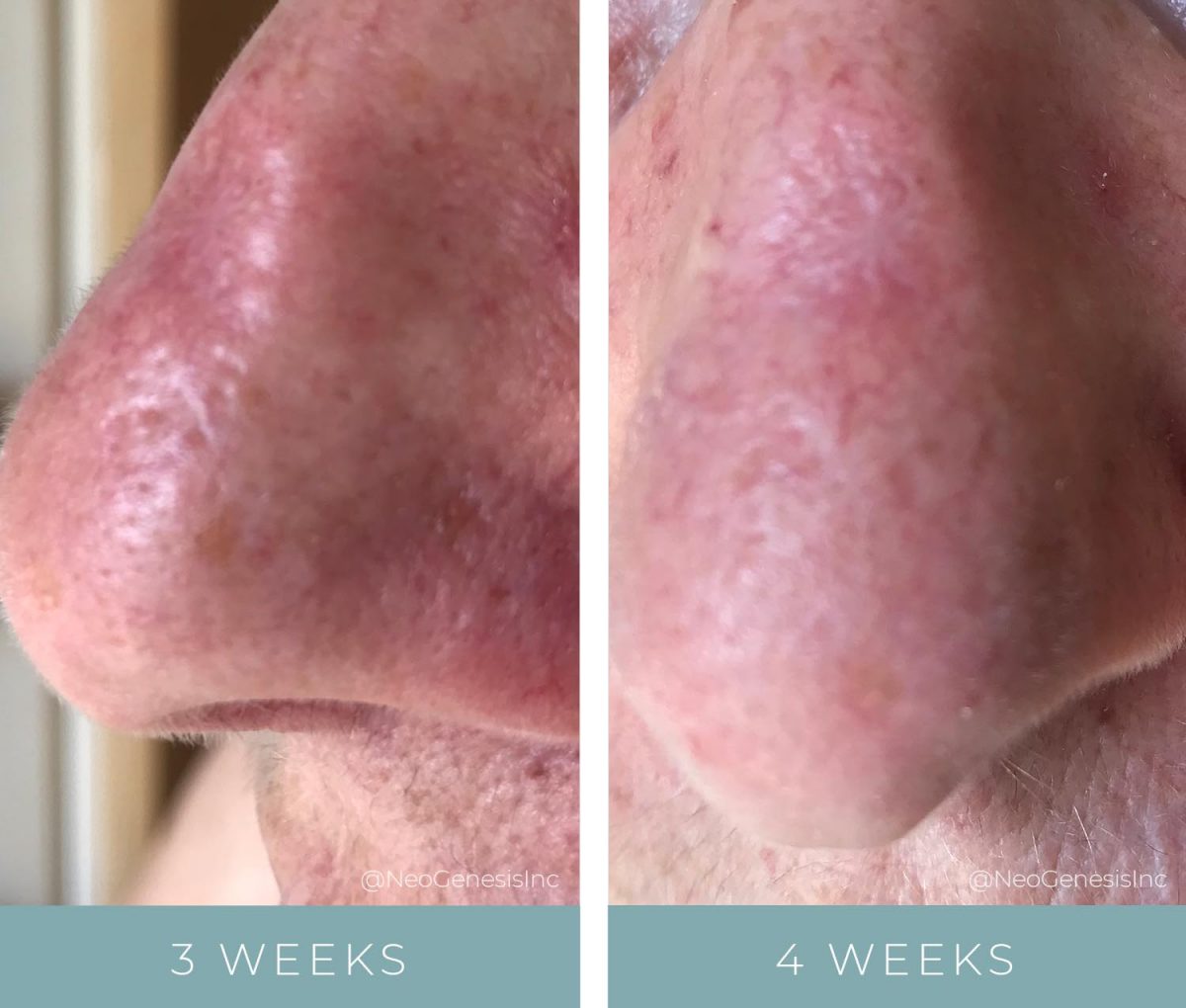 Before + After - Mohs Surgery 3 - NeoGenesis Pro Australia