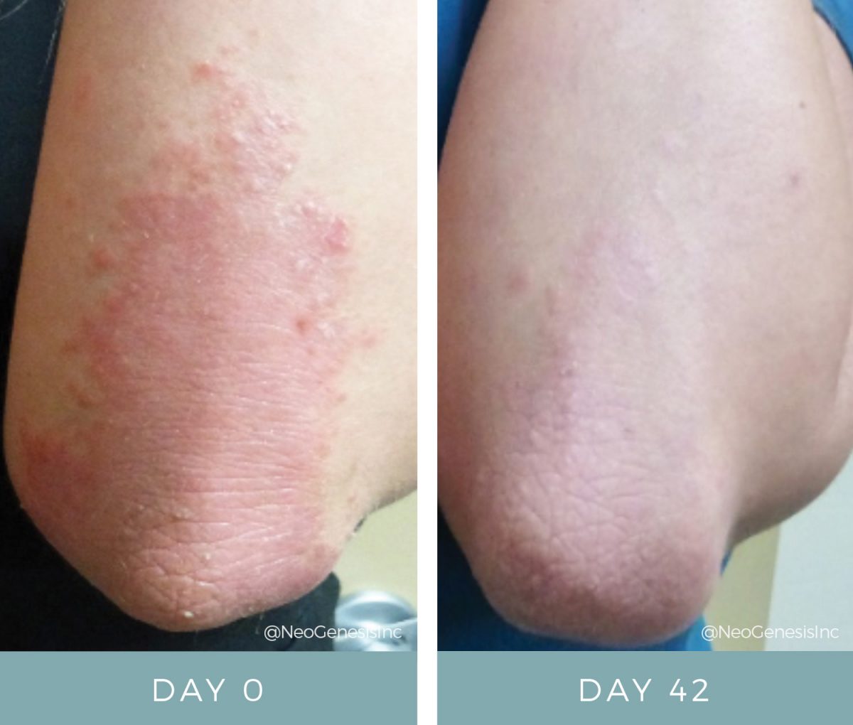 Helping Your Clients Manage Psoriasis NeoGenesis Skin Care Blog