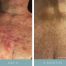 Radiation Dermatitis NeoGenesis Skincare After Radiation Oncology Safe