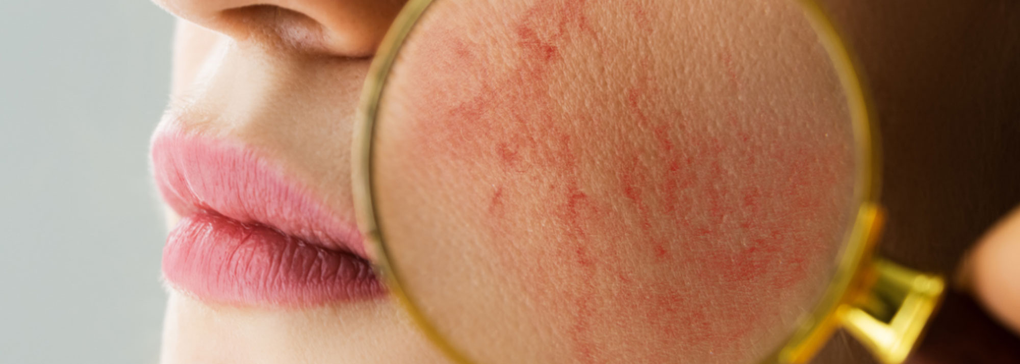 Rosacea Skincare Protocols | NeoGenesis Skin Care for Rosacea