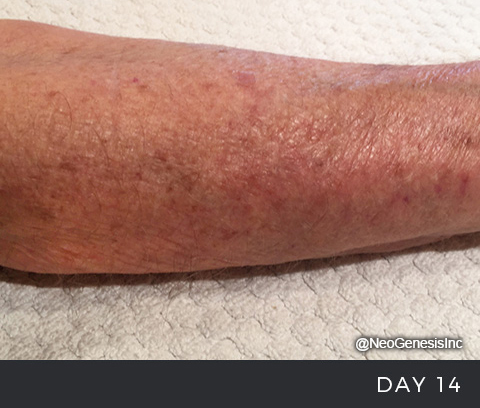 Actinic Purpura Archives - NeoGenesis Pro Australia