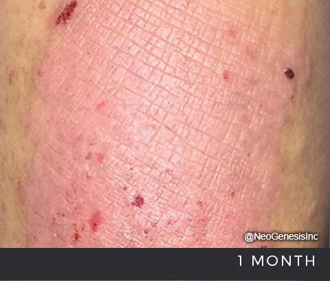 Soothe Chronic Dermatitis with NeoGenesis Recovery Serum