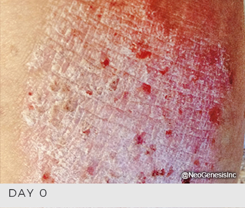 Soothe Chronic Dermatitis with NeoGenesis Recovery Serum