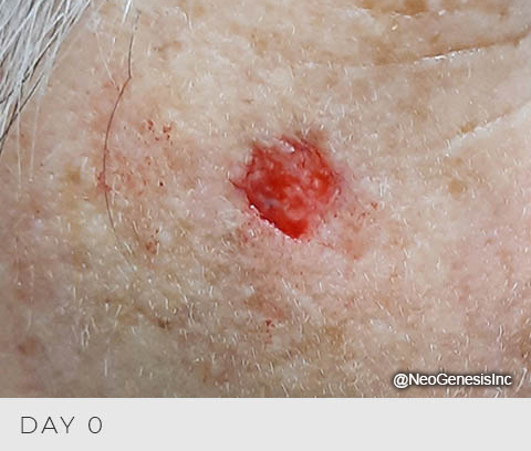 Cryotherapy for Pre-Cancerous Lesions Before + After Photos