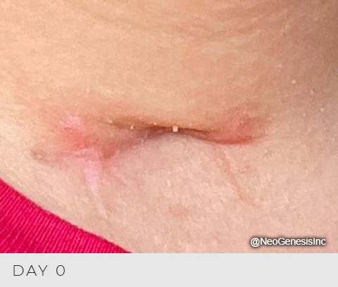 Tracheostomy Scarring Skin Care Products NeoGenesis