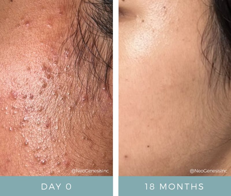 Oily Skin Acne Skincare for Acne NeoGenesis Recovery