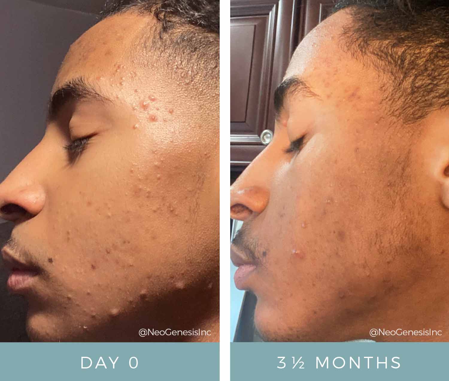 Acne Grades 2-3: Before and After Photos and Results