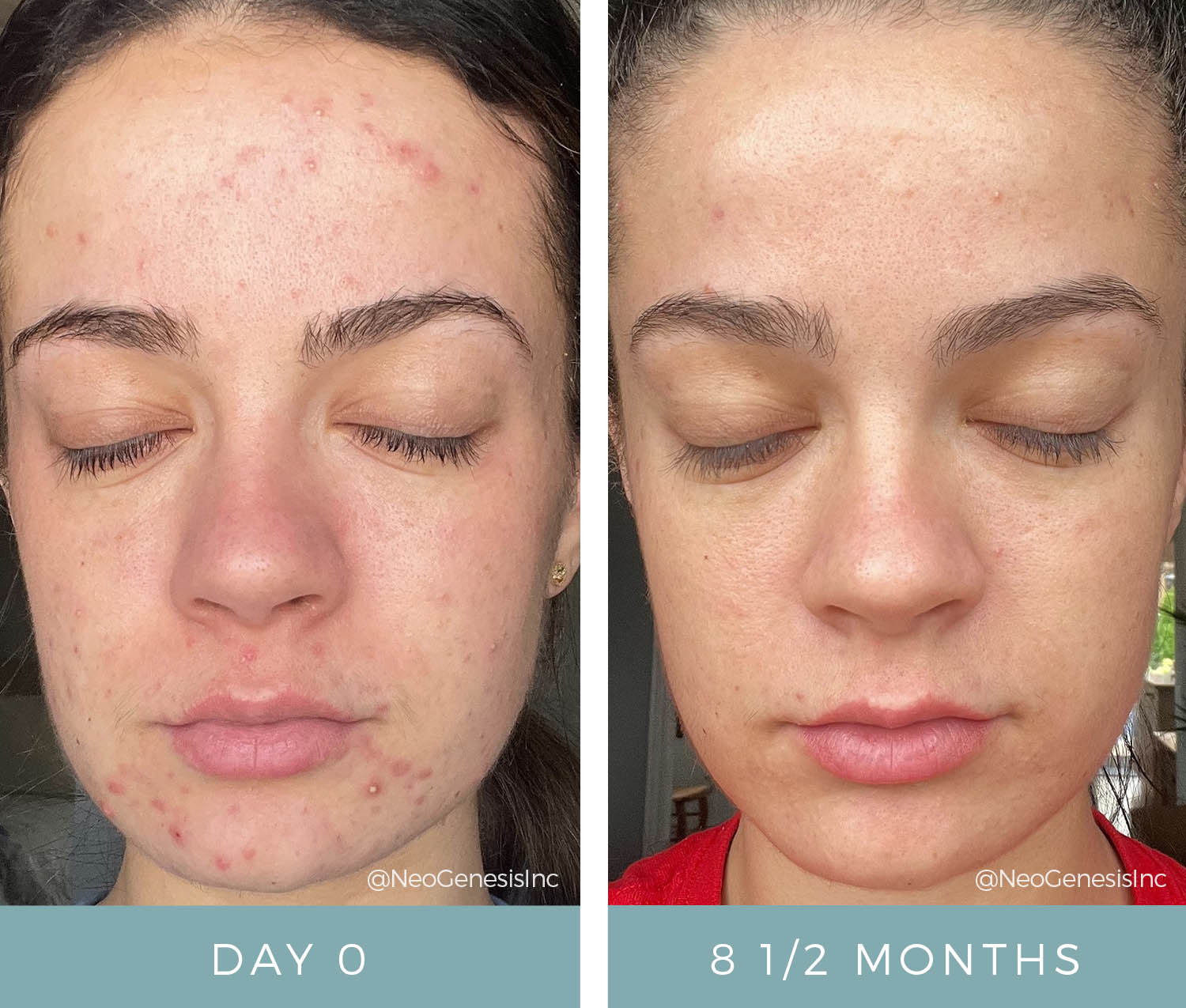 Amazing Results of NeoGenesis + Microneedling for Acne Scarring