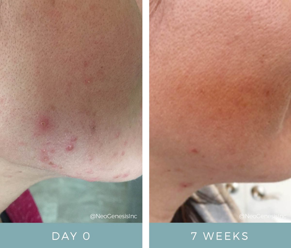 Achieving Clear Skin: The Power of NeoGenesis Recovery Serum