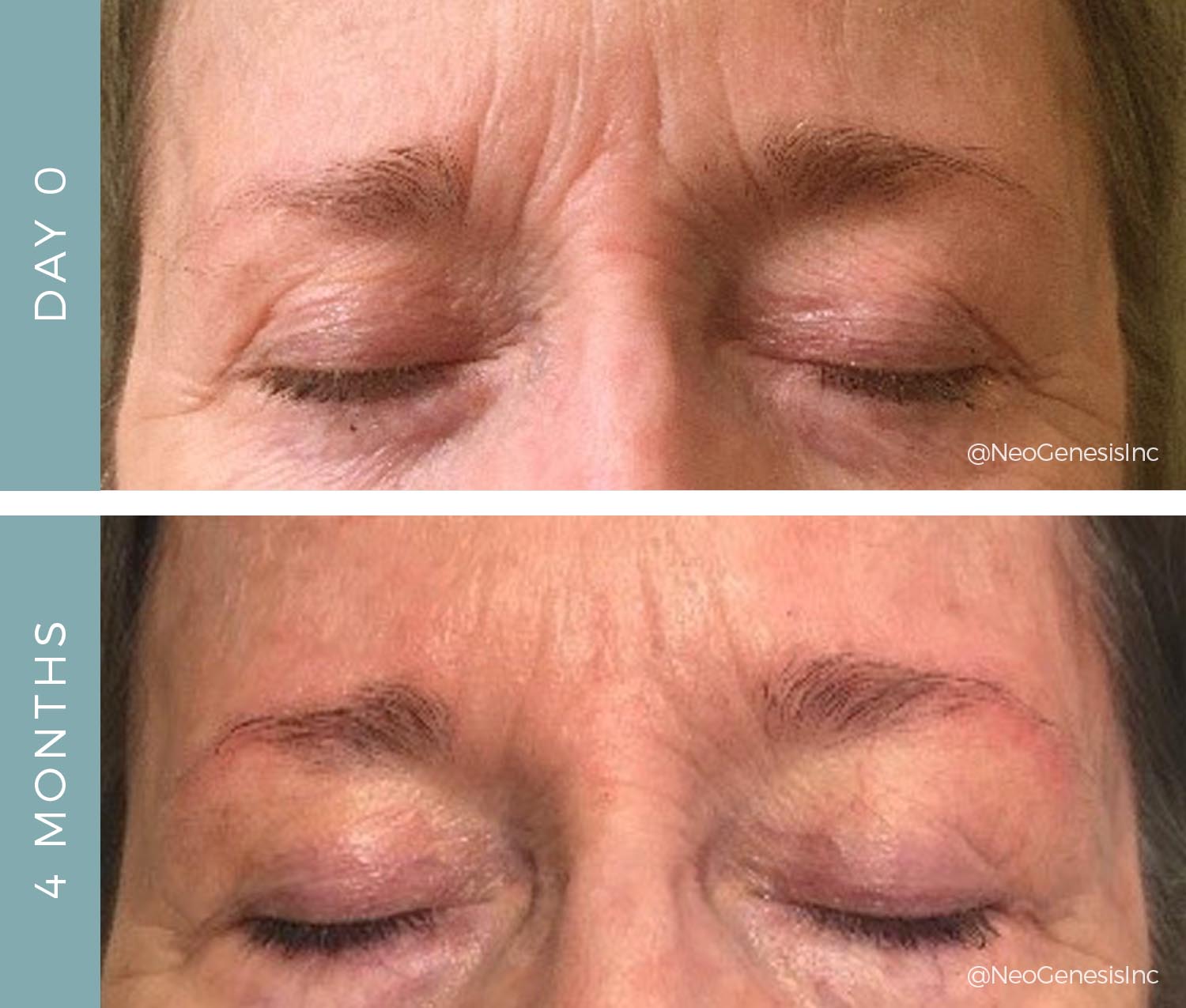 Ageing Skin Before and After: My Transformation with NeoGenesis