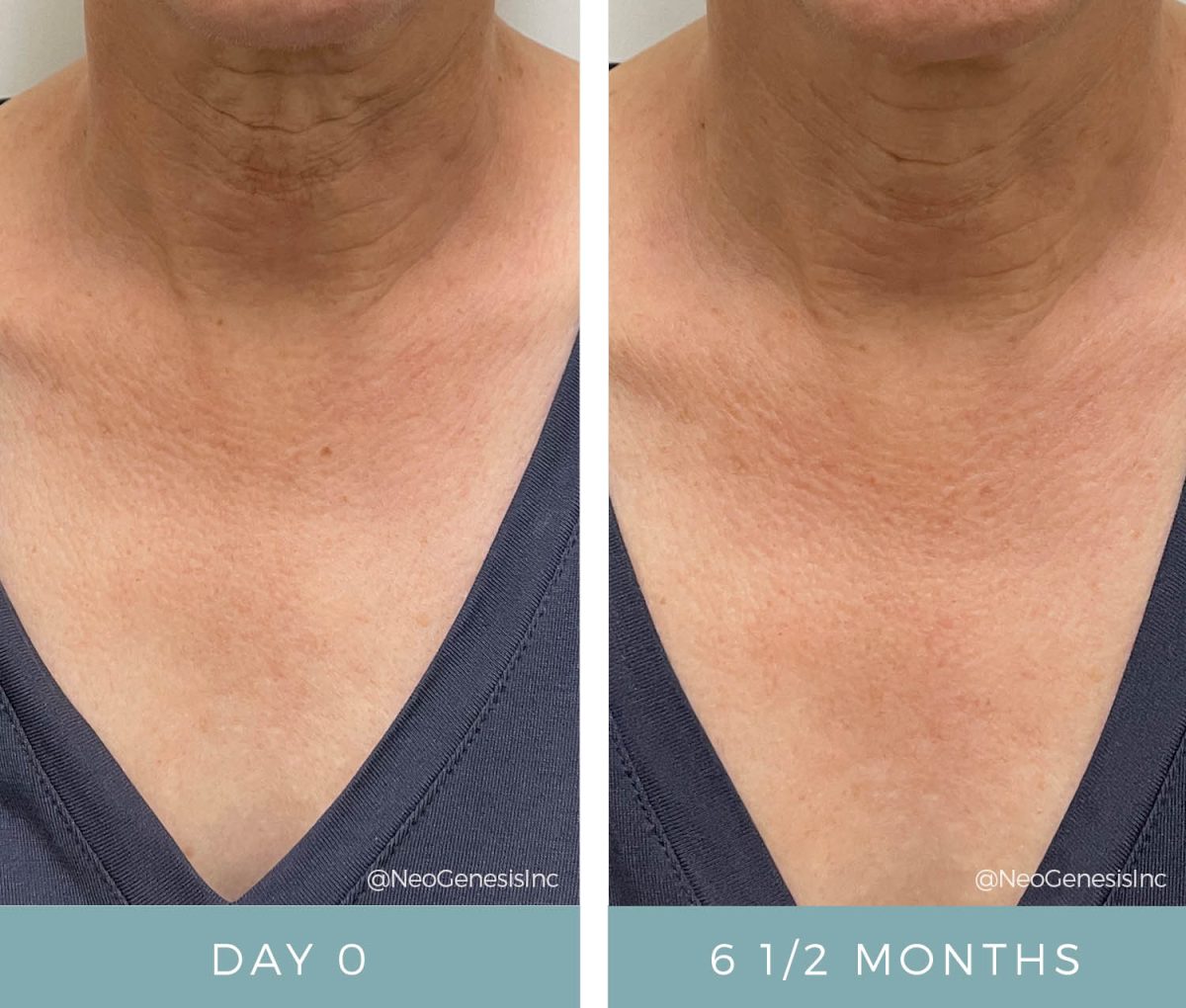 Addressing Ageing Neck Concerns with NeoGenesis Products