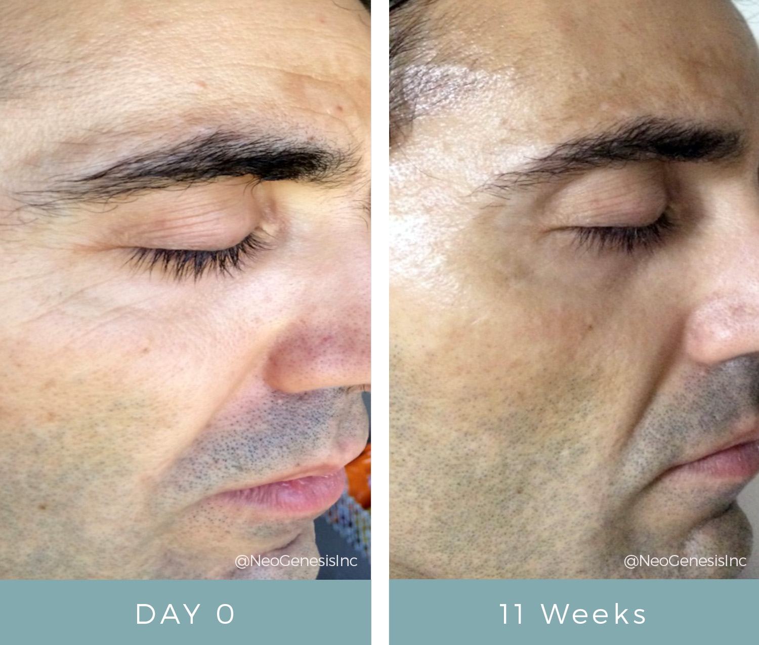 Effective Skincare for Men with Ageing Skin with NeoGenesis