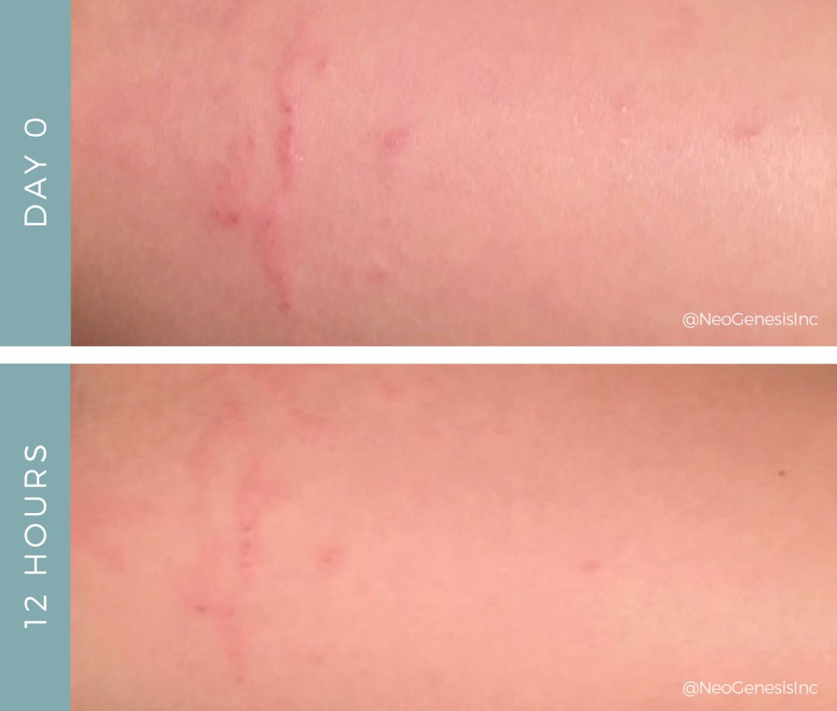 Allergic Reaction to Henna Tattoo: Before + After Photos