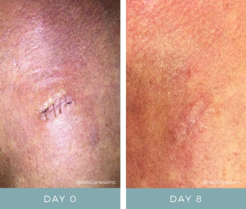 Melanoma Skin Cancer Surgery Skin Care