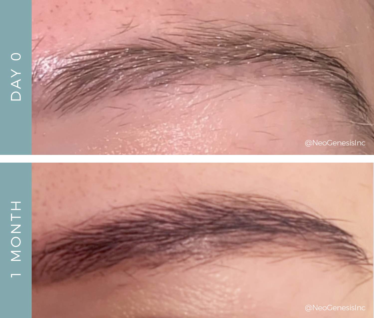 Revive Your Brows With NeoBrow: Effective Solution for Brow Loss