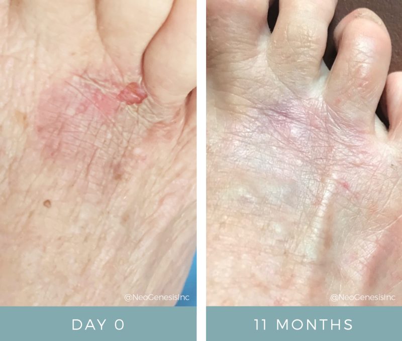 Boiling Water Burn Before + After NeoGenesis Recovery Serum