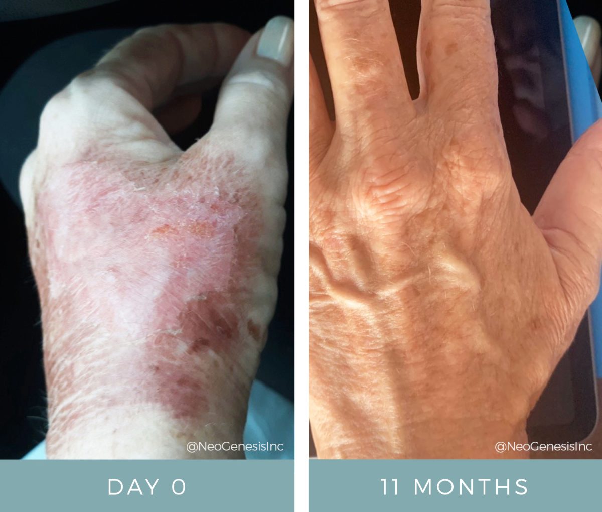 Boiling Water Burn Before + After NeoGenesis Recovery Serum