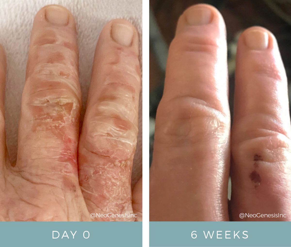 Burns Wound Care Before + After Photos NeoGenesis Skin Care
