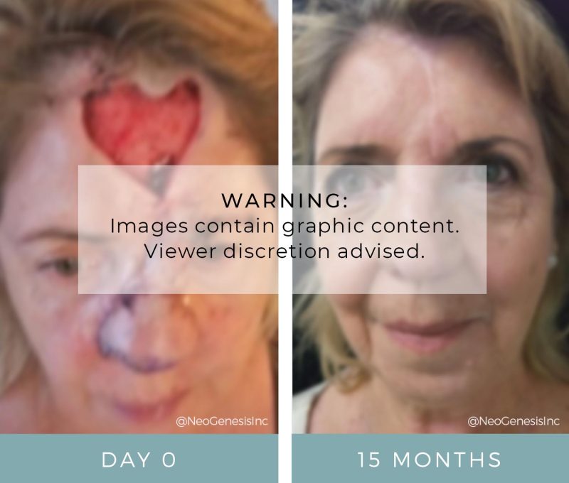 Mohs Surgery for Skin Cancer Before + After NeoGenesis Products
