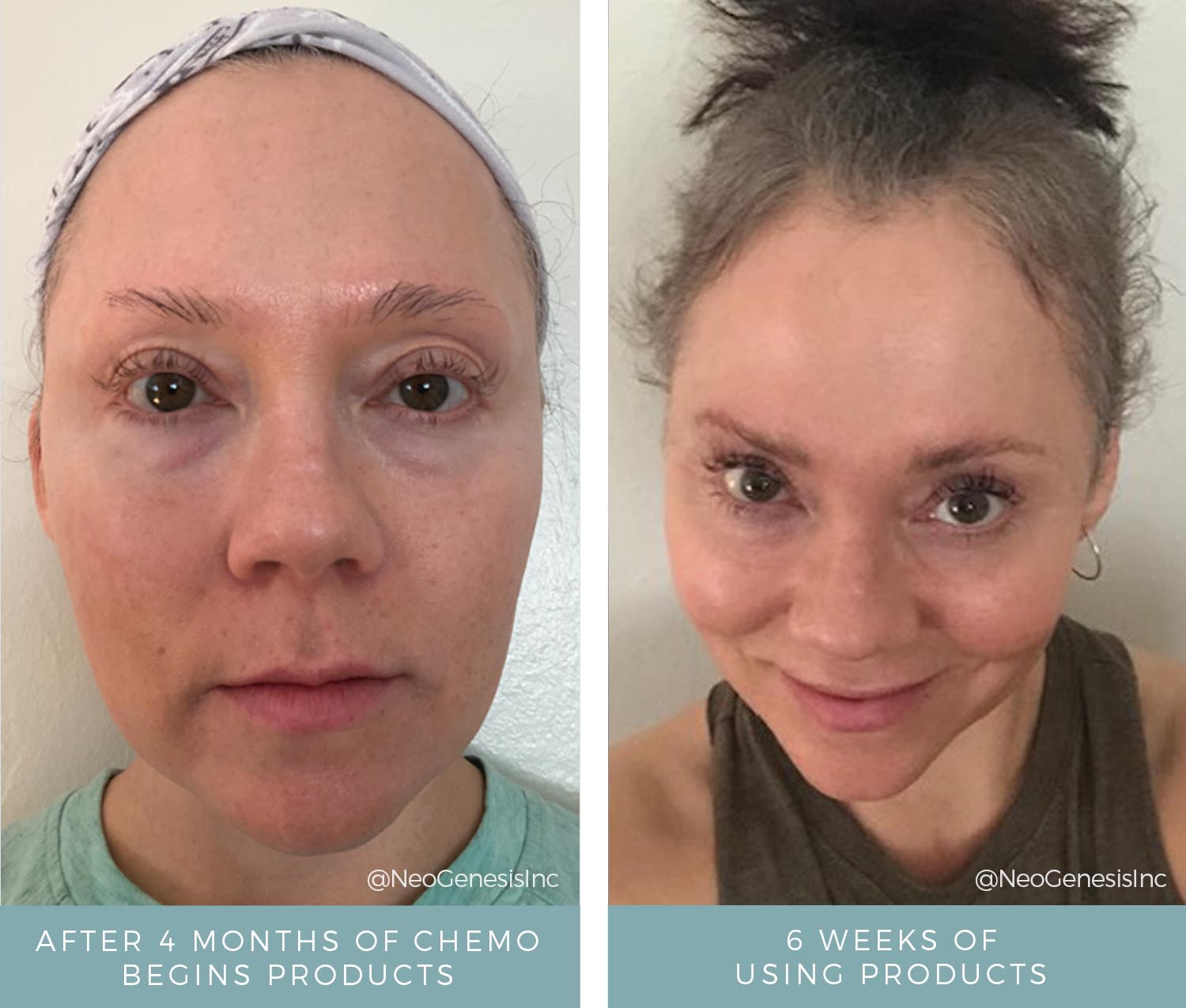 Chemotherapy Hair Lash Brow Loss Before + After Photos