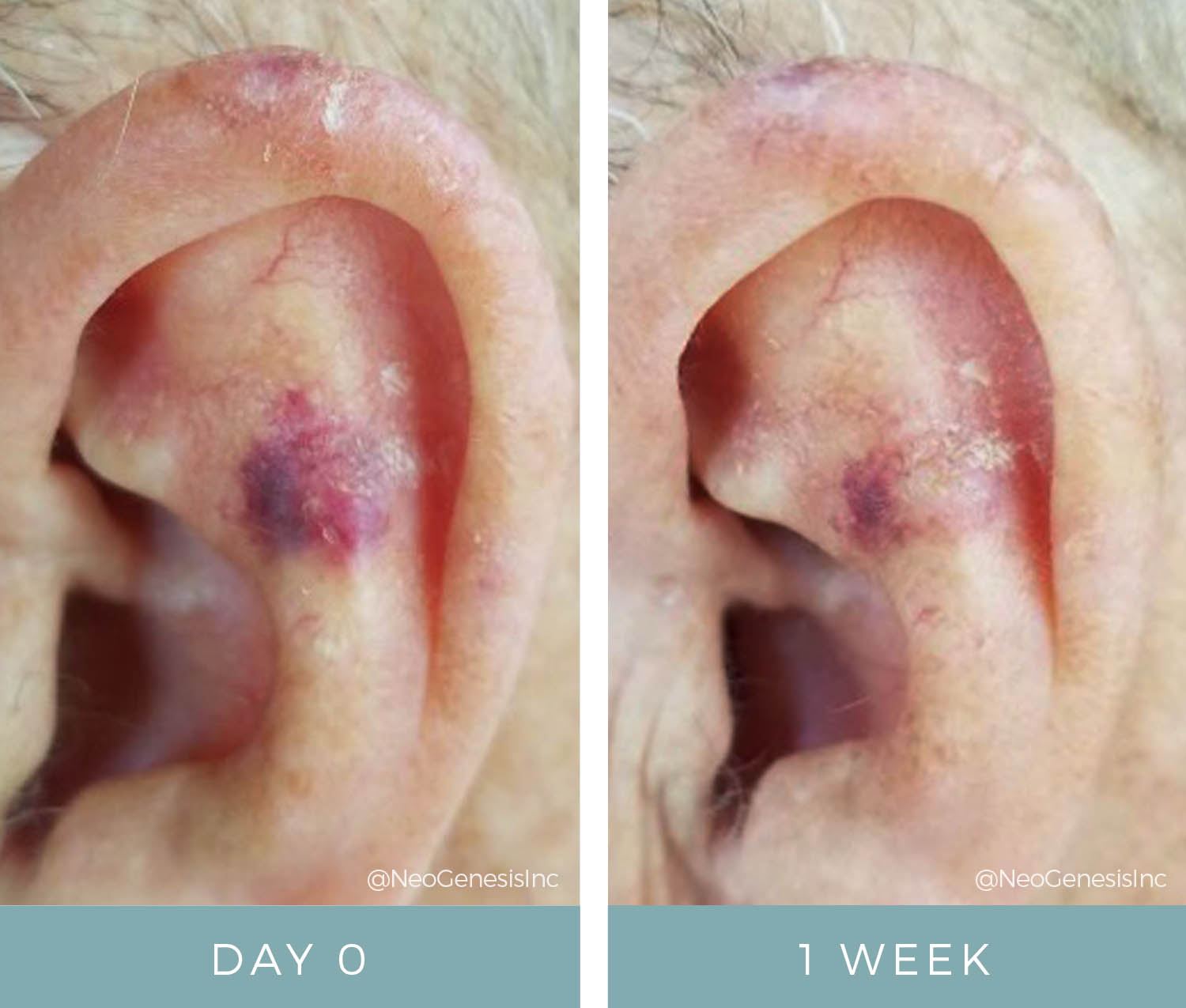 Topical Chemotherapy Side Effects Before + After NeoGenesis