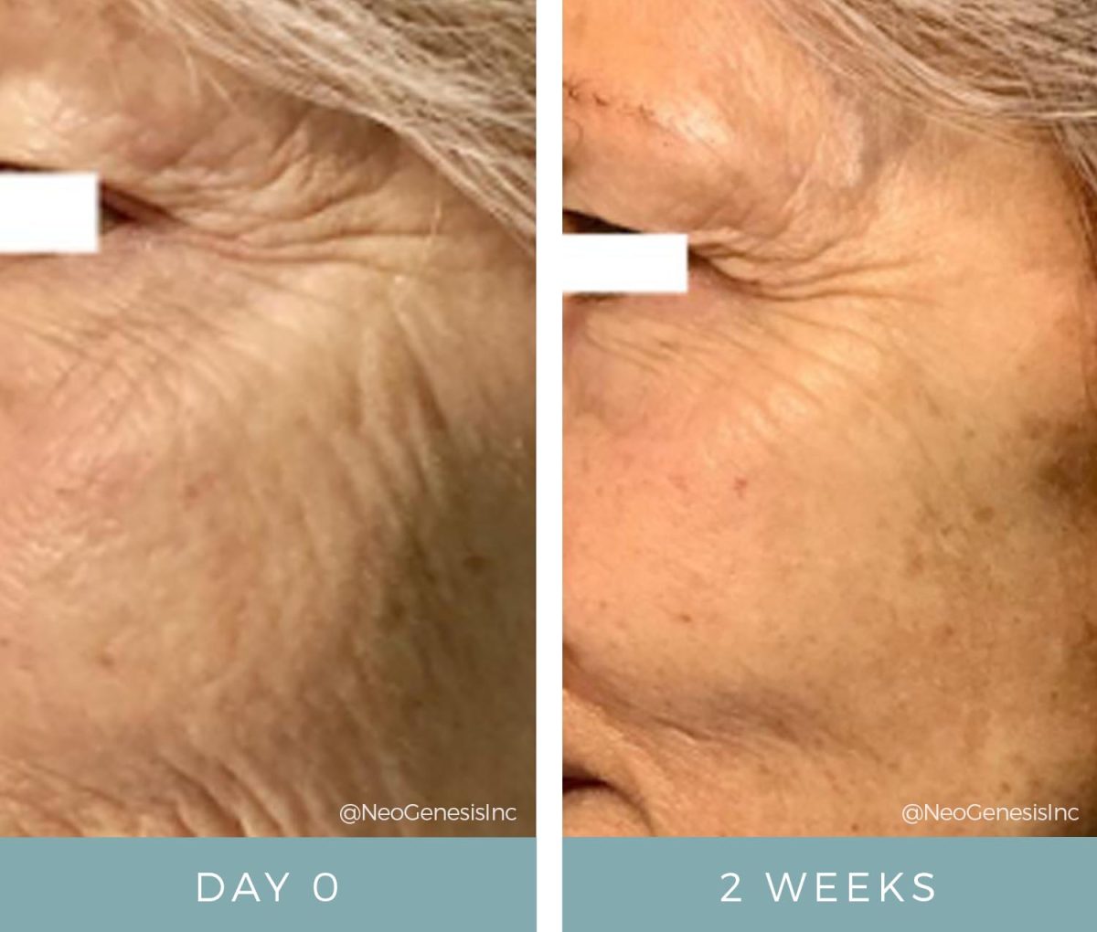 Fibroblast Before + After Skin Care Products Post Fibroblast