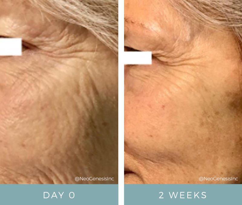Fibroblast Skin Tightening The Benefits for Ageing Skin