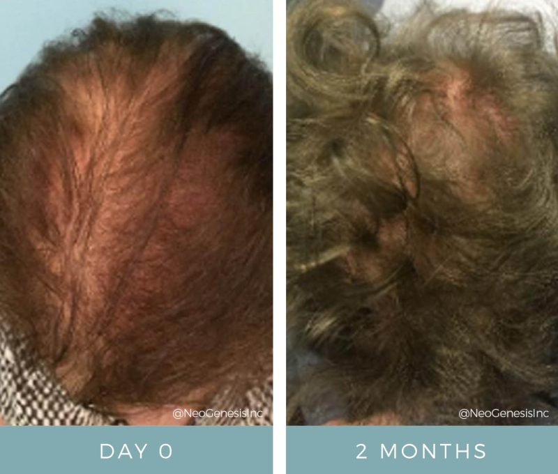 Hair Loss: Say Goodbye to Hair Loss with Hair Thickening Serum