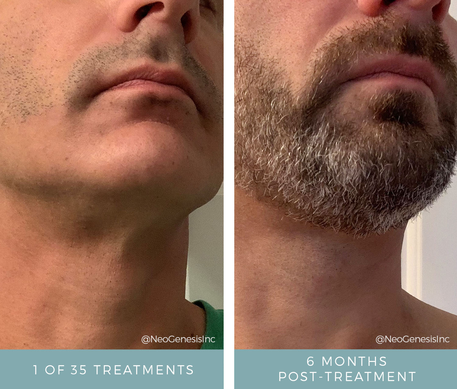 Beard Loss Radiation Before + After Photos Hair Thickening Serum