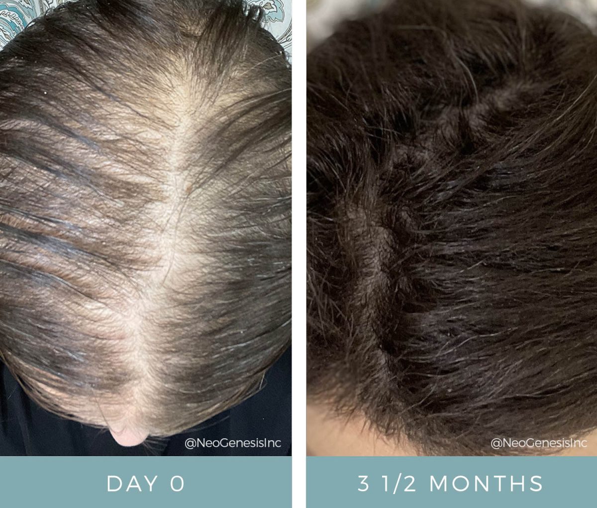 Chemotherapy Hair Loss | NeoGenesis Hair Thickening Serum