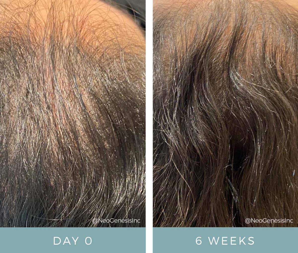 Hair Loss + Microneedling: An Effective Treatment Option