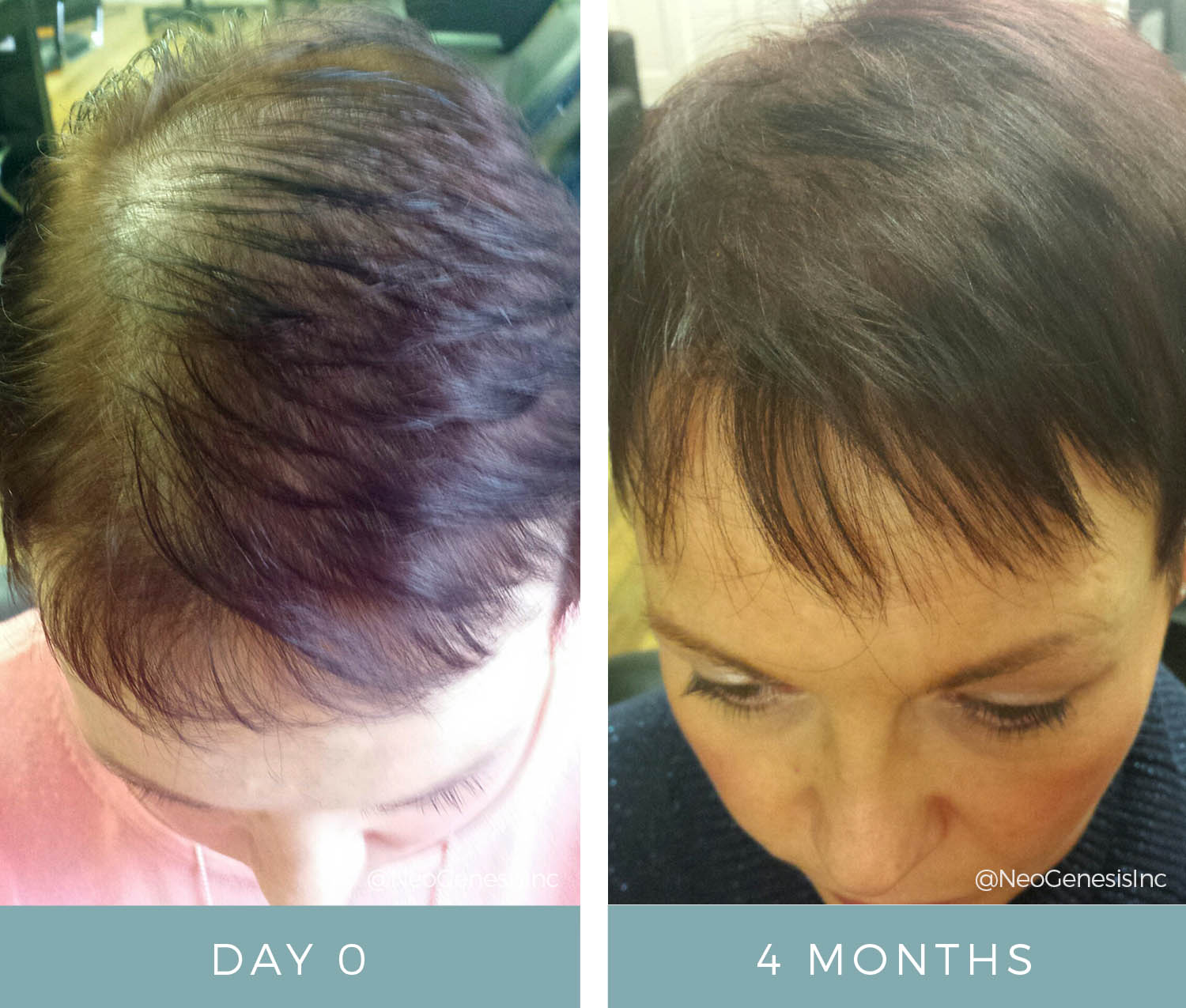 NeoGenesis Hair Thickening Serum for Hair Loss