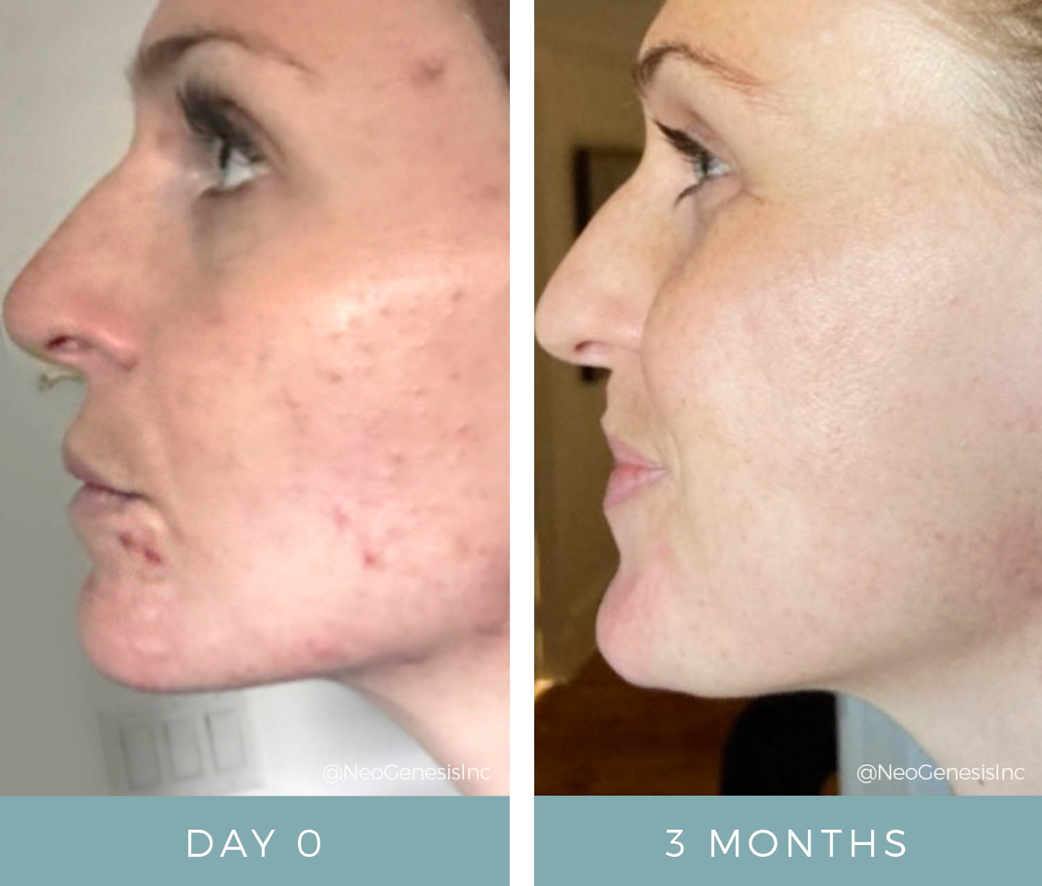 Transform Your Skin: Before and After Results of Hormonal Acne