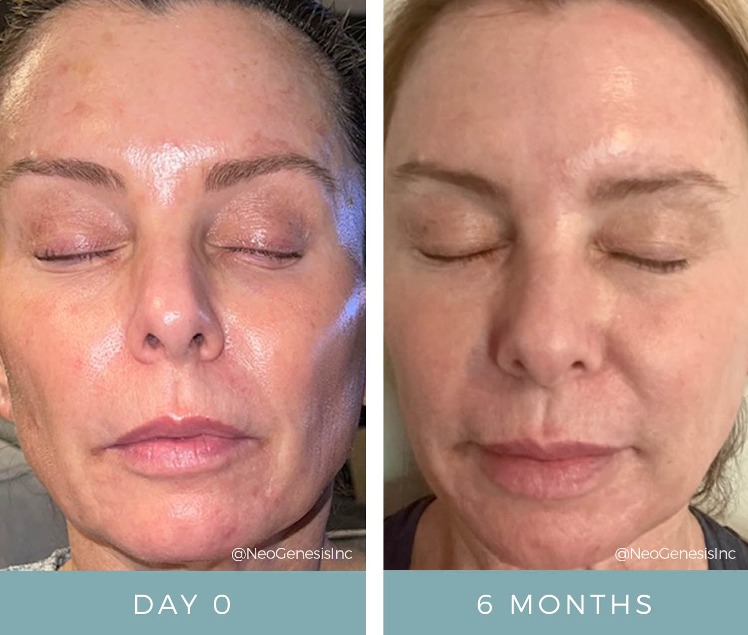 Skincare Routine for Hormonal Acne and Hyperpigmentation