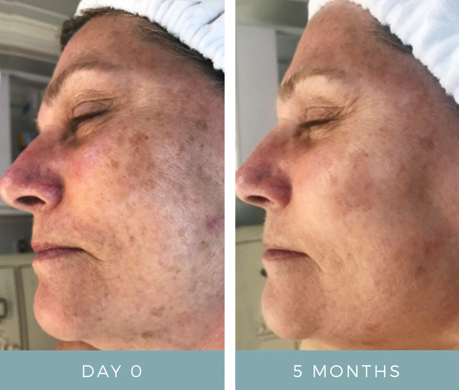 The Best Products for Hyperpigmentation