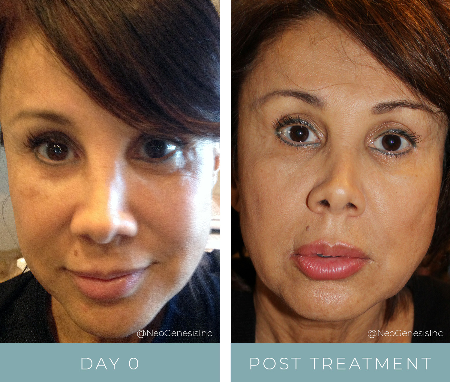 Achieve Clear and Even Skin: Dealing with Hyperpigmentation