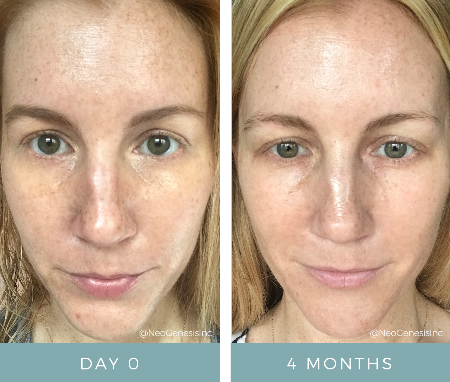 Hyperpigmentation Skin Care Product Before + After
