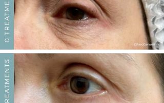 Jet Plasma Archives - NeoGenesis Pro Australia