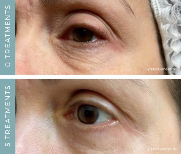 Jet Plasma Therapy for Skin Rejuvenation: Before and After Photos ...