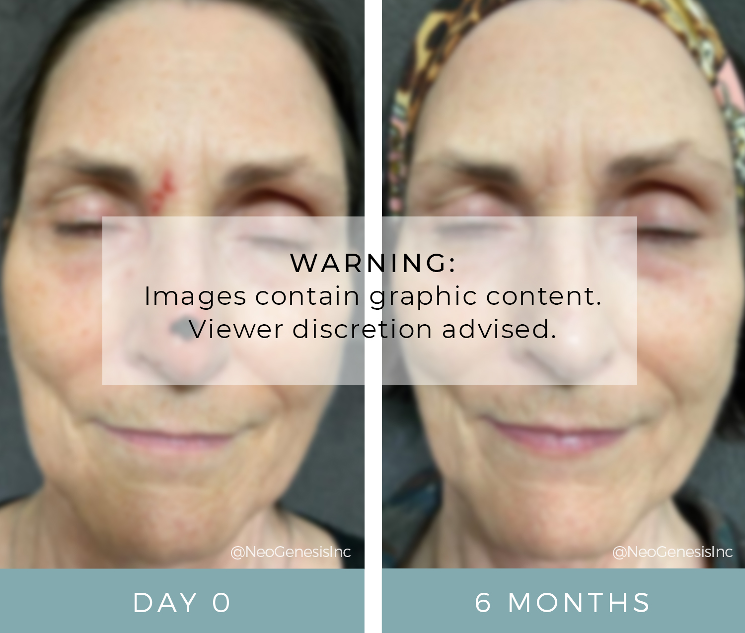 Wound Care for Lesions NeoGenesis Skin Care Products