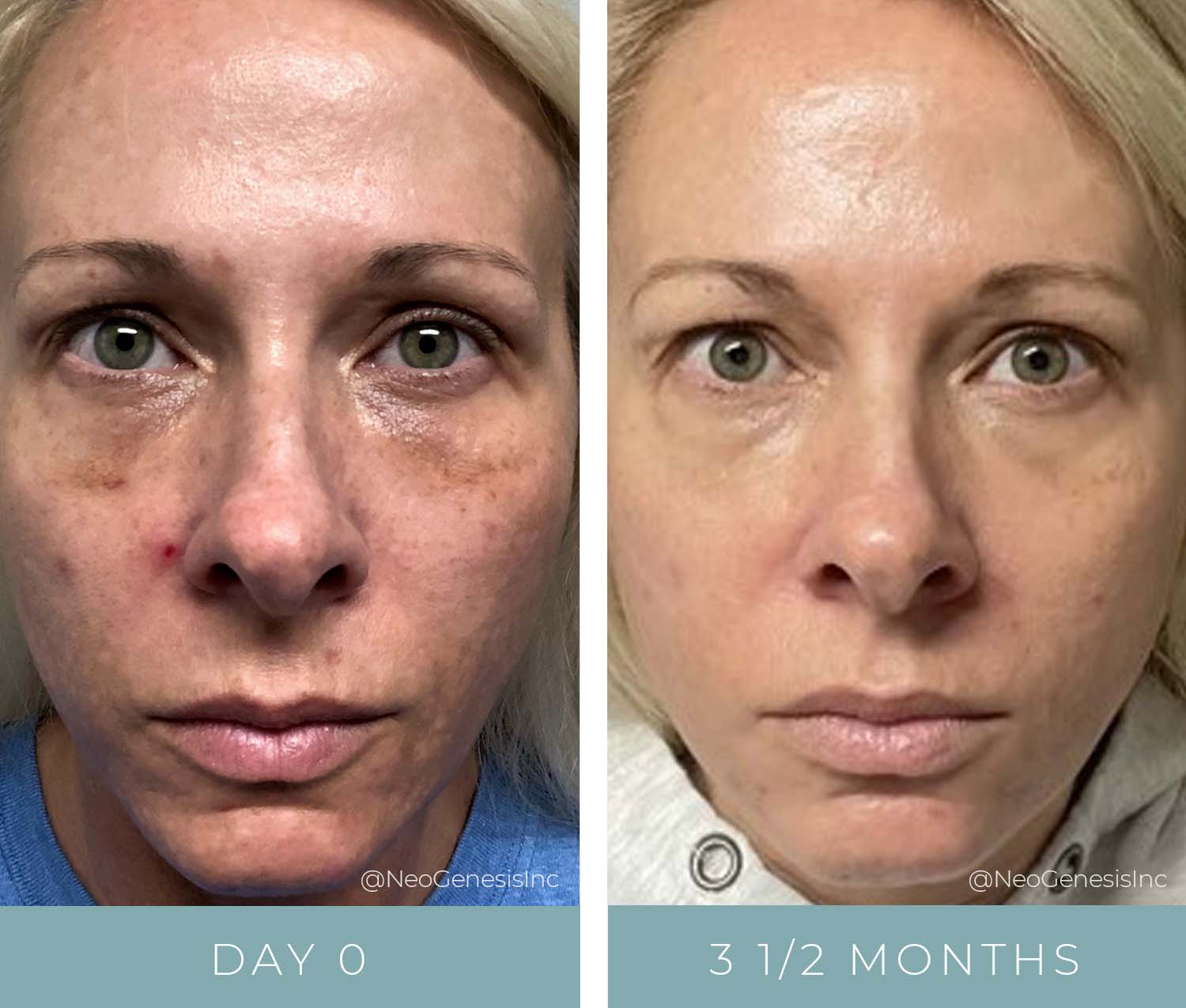 Melasma Skincare: Achieve a Brighter, More Even Complexion